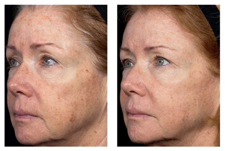 5 Reasons to Get a Fraxel Laser Treatment - Healthylooks Medspa